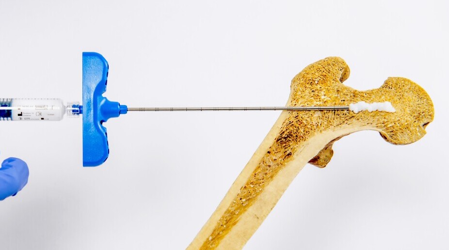 "Injectable bone" gel may be a radically better treatment for ...